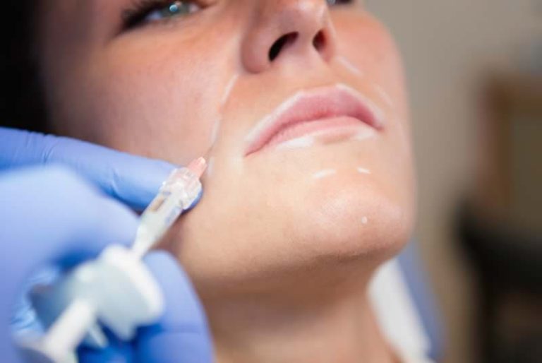 Dermal Fillers in Eltham London | AR Smiles London