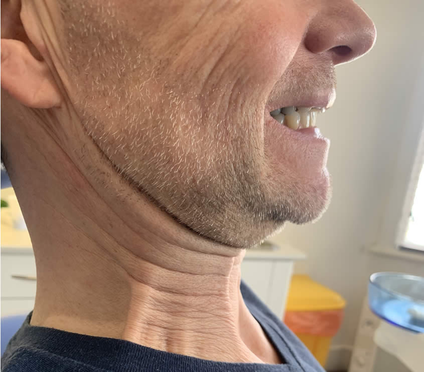 Nose and Neck - AR Smiles